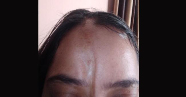 localized morphea forehead