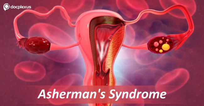 Asherman’s Syndrome: A Rare Aftermath Of Dilation And Curettage Procedures