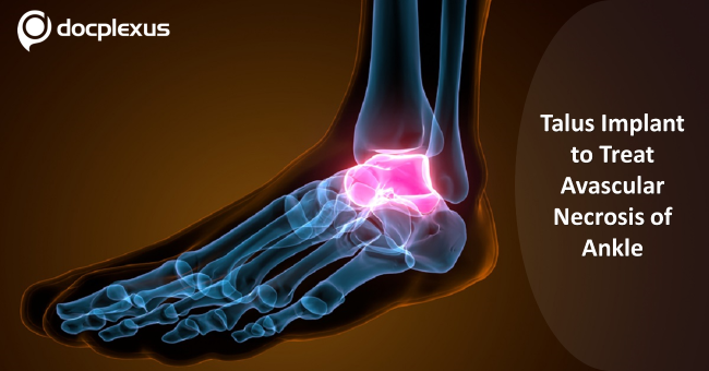 Talus Bone Replacement