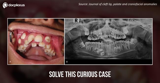 extra teeth in palate